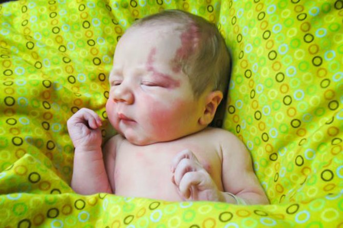 Decoding Your Baby's Birthmark: A Guide for Concerned Parents
