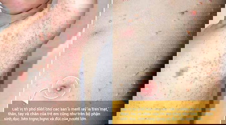 Bé bị nổi mẩn đỏ không ngứa là bệnh gì? Có nguy hiểm không?