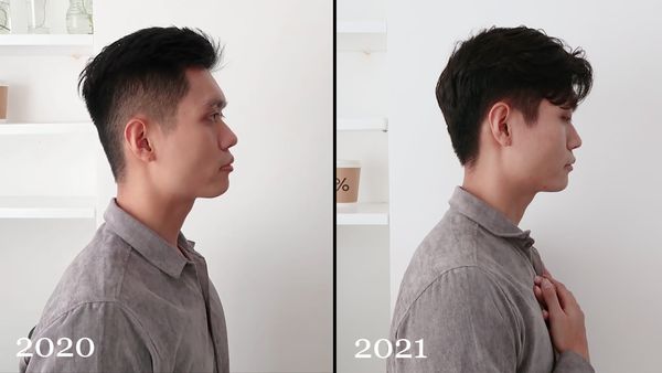 Mewing là gì? Phương pháp thẩm mỹ vi diệu không đụng dao