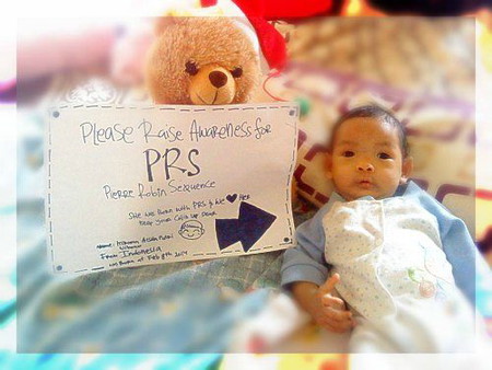 Kisah Nyata, Anakku Lahir dengan PRS (Sindrom Pierre Robin)