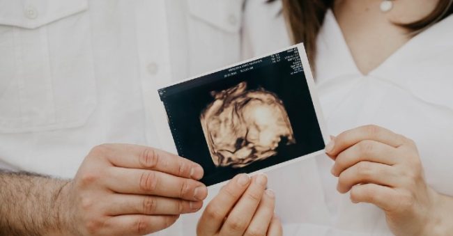 USG 4 Dimensi - Kelebihan dan Kekurangan USG 4D Dibanding 2D, 3D