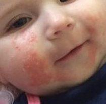 20 Types of Skin Rashes in Babies, Causes and How to Treat them