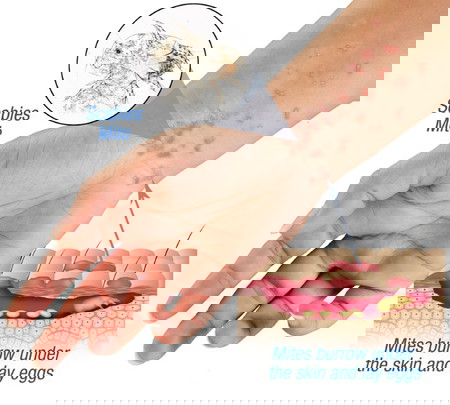 Scabies pada Bayi - Penyebab, Gejala, dan Cara Mengobati