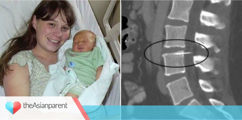 Bahaya suntik epidural - Jarum tertinggal sebabkan kerusakan saraf