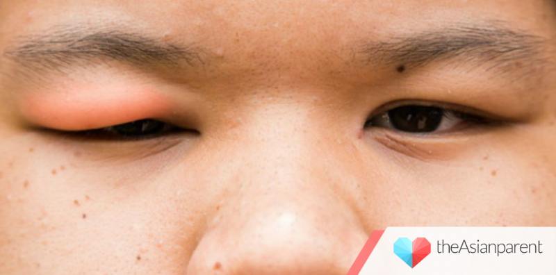 6 Cara Mengatasi Mata Bengkak, Penyebab, dan Obatnya