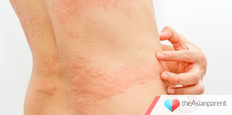 Alergi Dingin: Gejala, Penyebab, dan Cara Mengatasinya