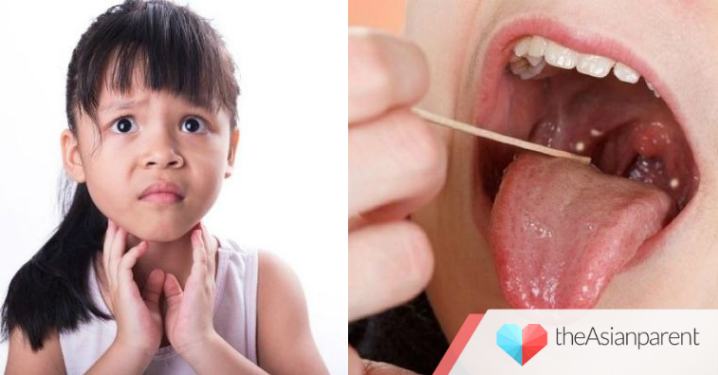 3 Cara Mengobati Amandel secara Alami pada Anak
