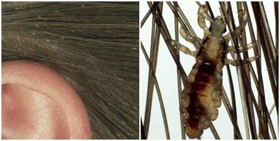 Kutu rambut pada anak, mengenal siklus hidup kutu dan cara mengatasinya