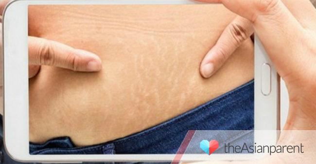 5 Cara Menghilangkan Stretch Mark dengan Bahan Alami