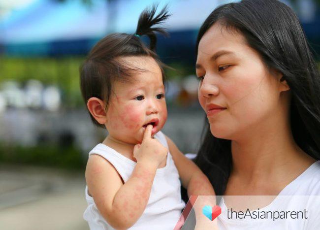 Dermatitis atopik pada anak bisa dicegah dengan pemilihan nutrisi tepat