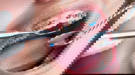 Cabut gigi saat hamil bisa ganggu pertumbuhan janin, benarkah?