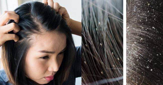 Obat kutu rambut alami yang aman bagi ibu hamil, catat Bunda!