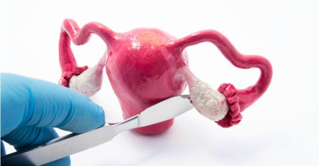 Infeksi Indung Telur (Ovaritis) - Gejala, komplikasi, dan penanganan