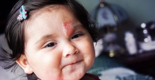 Tanda merah pada bayi baru lahir bisa hilang atau tidak? Ini jawabannya