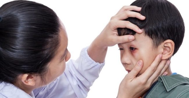 Luka memar pada anak bisa diatasi dengan 5 cara ini, Bunda perlu tahu!