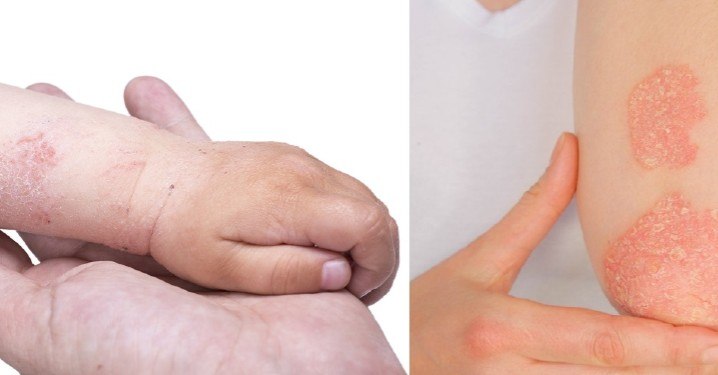 Kulit mengelupas, ini 8 penyebab dan tips mengatasinya dari dokter