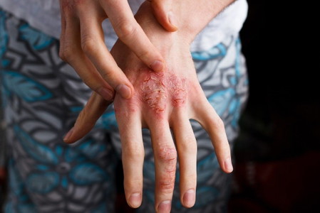 Hand Dermatitis - Gejala, Penyebab dan Cara Mencegahnya