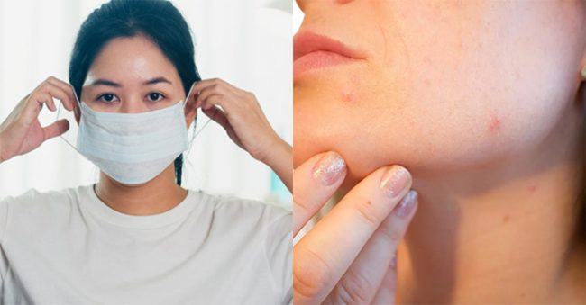 3 Cara Mencegah Mask Acne Atau Jerawat Masker