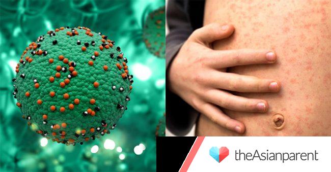 Penyakit Campak: Gejala, Penyebab, dan Cara Mengobatinya