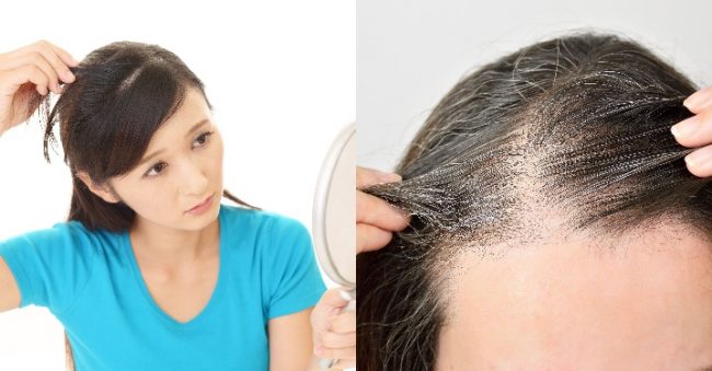 7 Cara Menghilangkan Uban dengan Bahan Alami yang bisa Parents Coba