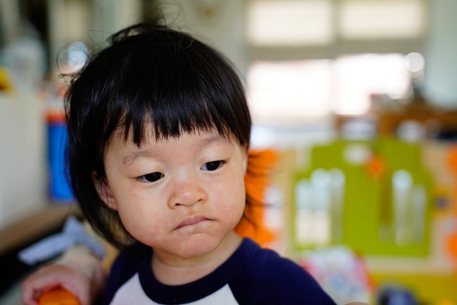 Alergi Protein Susu Sapi Bisa Diatasi dengan Cara Ini, Nutrsi Anak Optimal