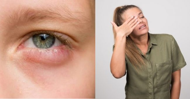 8 Penyebab Mata Bengkak dan Cara Mengobatinya, Parent Perlu Tahu