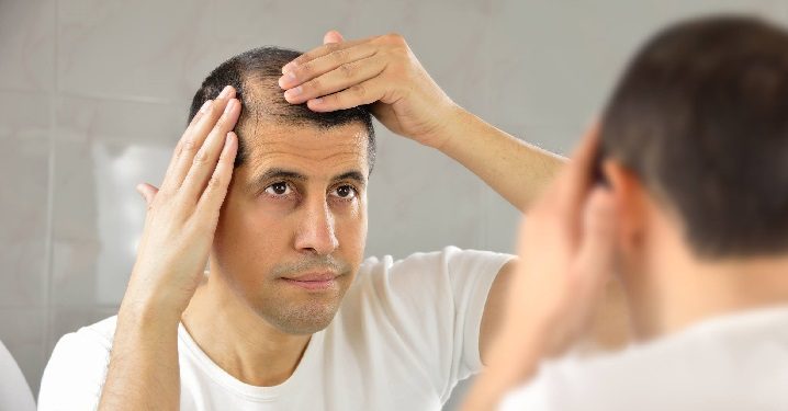 5 Tanda Kebotakan dan Cara Efektif untuk Mengatasinya