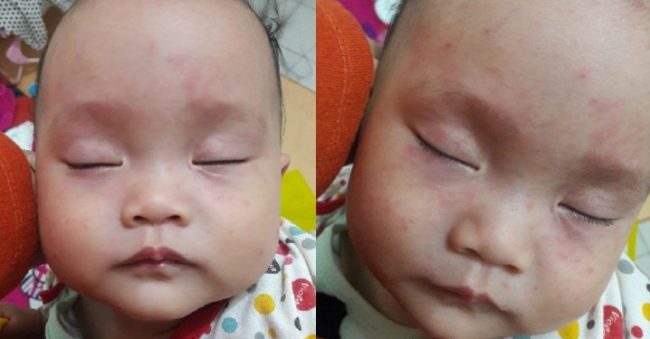 Anakku Alami Ruam Merah, Apakah Tanda Sakit Campak?