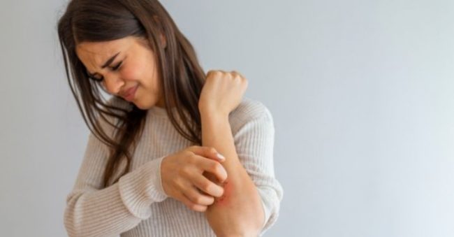 Dermatitis Numularis: Gejala, Penyebab, dan Cara Mengobatinya