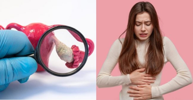 Penyakit Kanker Ovarium: Gejala, Penyebab, Cara Mengatasi