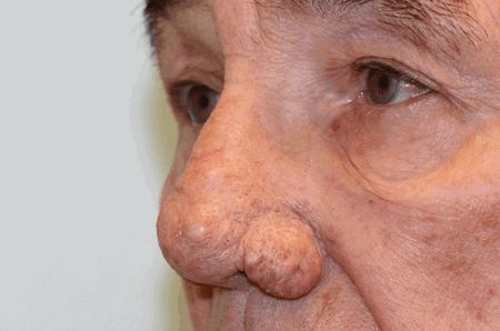 Waspadai Rinofima, Penyebab Hidung Besar dan Merah