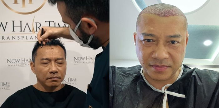 Anang Hermansyah Cangkok Rambut Malah jadi Botak: "Biar Istri Senang"