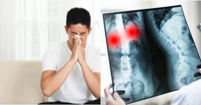 Penyakit Florona, Flu & Corona, Ini Gejala yang harus Diwaspadai