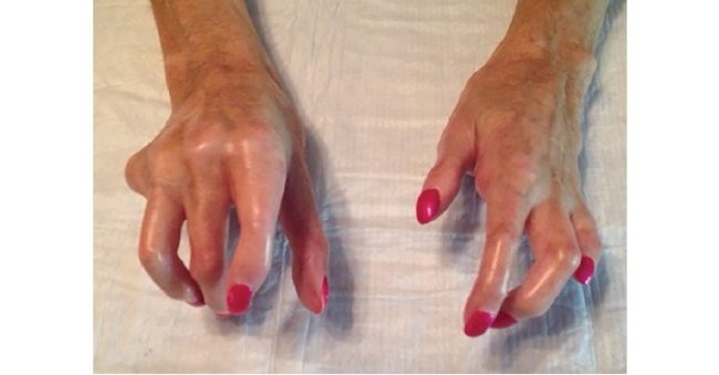 Skleroderma - Penyebab, Gejala, Cara Mengobati