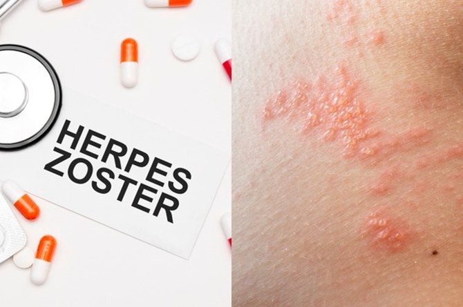 Herpes Zoster Vaccine: General Explanation, Effectiveness, and Side Effects