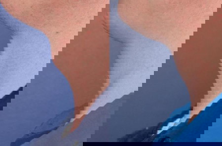 Dinda Syarif Jalani Operasi Jakun, Ini Bahaya dan Efek Sampingnya