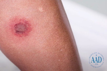 Infeksi Jamur Ringworm Pada Kulit, Kenali Jenis dan Gejalanya!