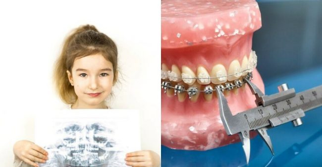 Gigi Bertumpuk pada Anak: Tanda, Penyebab, Cara Mengatasi