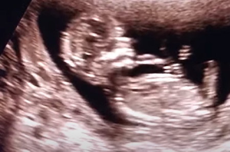 USG Kehamilan: Jenis, Tujuan dan Cara Membacanya