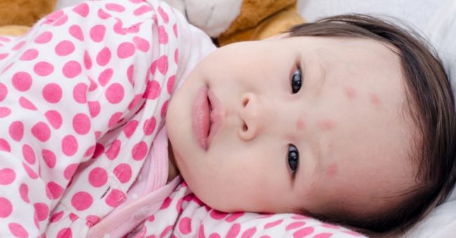 Ciri-ciri DBD pada Bayi yang Harus Parents Diwaspadai