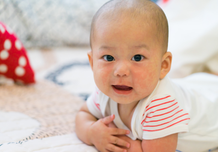 7 Ciri-ciri Bayi Kena Campak yang Wajib Waspadai