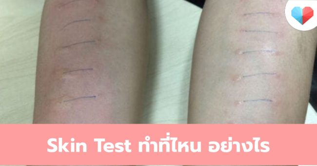 Skin Test ทำอย่างไร ทำที่ไหน ราคาเท่าไหร่ - theAsianparent.com