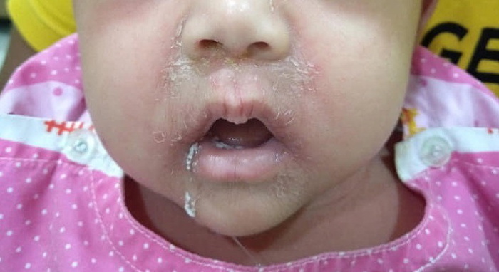 โรค 4s คือ โรค staphylococcal scalded skin syndrome (SSSS) อาการโรค 4s