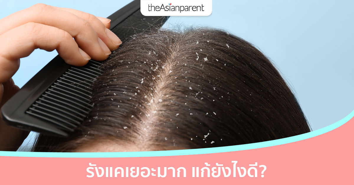 แนะนำ! วิธีขจัดรังแค ด้วยตัวเอง แบบง่าย ๆ บอกลาปัญหารังแคกวนใจ