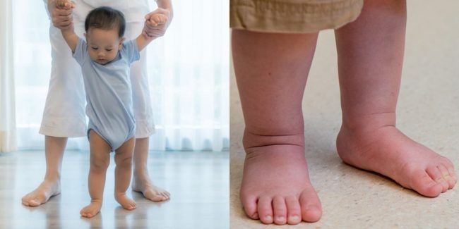 Tapak Kaki Anak Rata, Ini Cara Untuk Kenal Pasti Dan Betulkannya