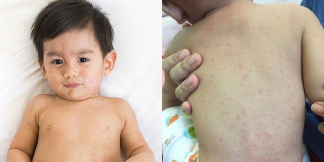 Campak Pada Bayi: Ini Cara Merawatnya!