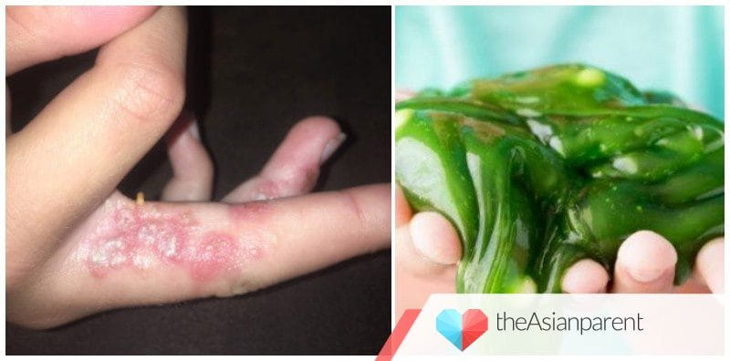 Is Slime Dangerous? Girl's Hands Blistered After Playing With Slime
