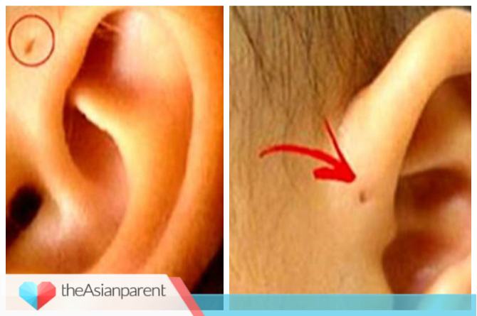 Preauricular Ear Pit Baby: Should Parents Be Worried About This Hole?
