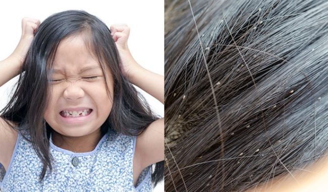Cara Hilangkan Kutu Rambut Kepala Anak & Elak Kutu Bertelur Lagi!