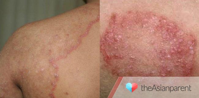 Kurap Kering: Ini Cara Efektif Untuk Hilangkan Kegatalan